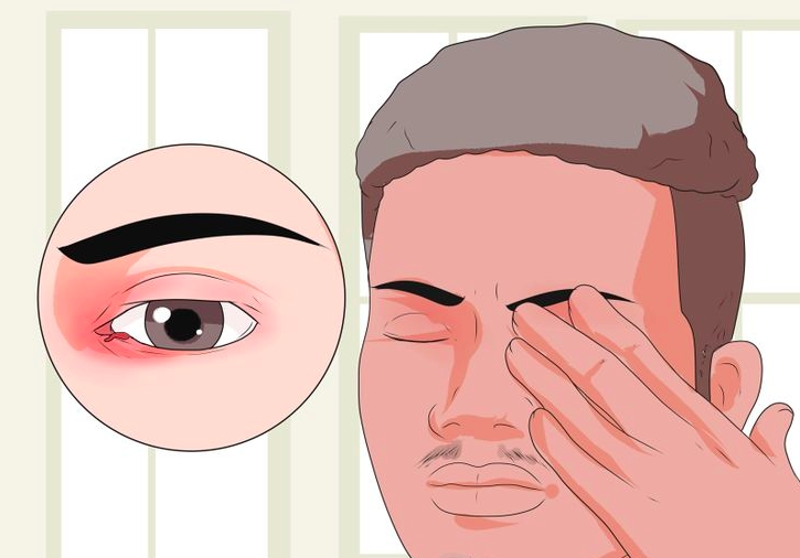 4 remedios caseros para tratar el picazón de ojos. ¡Son efectivos ...